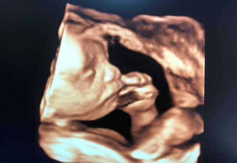 Ecografie fetală - Gyndia - Cabinet Obstetrică-Ginecologie Sibiu